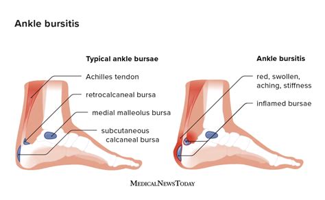 Ankle Bursitis Symptoms Causes And Treatment