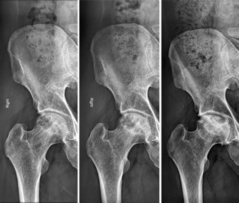 Osteonecrosis Of The Hip Xray