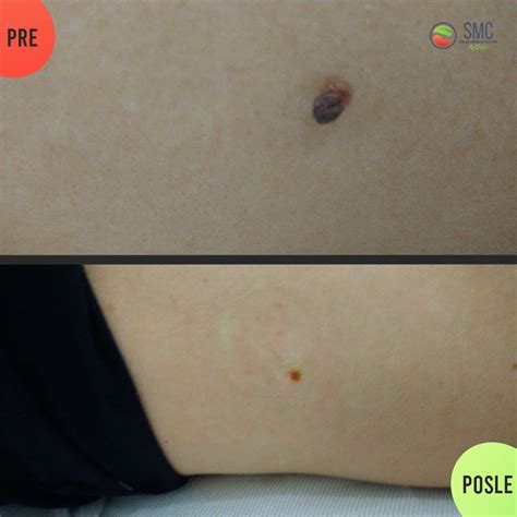 Uklanjanje Mladeža Radiotalasnom Metodom