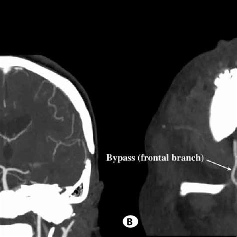 A Postoperative Coronal Ct Angiogram Confirms Patency Of Bypass With Download Scientific A Postoperative Coronal Ct Angiogram Confirms Patency Of Bypass With Download Scientific