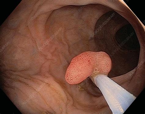 Colon Polyp Removal Stock Image C014 6897 Science Photo Library