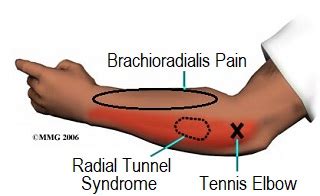 Brachioradialis Tendon