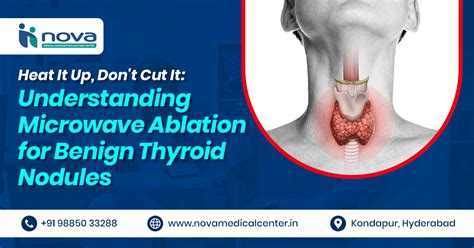 Understanding Microwave Ablation For Thyroid Health A Non Surgical