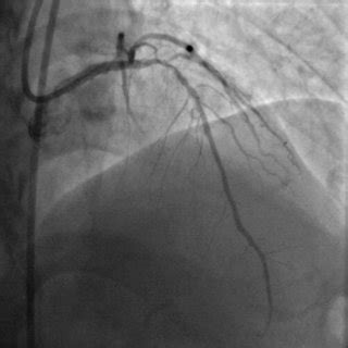 B Left Coronary Artery Angiography LCx Download Scientific Diagram