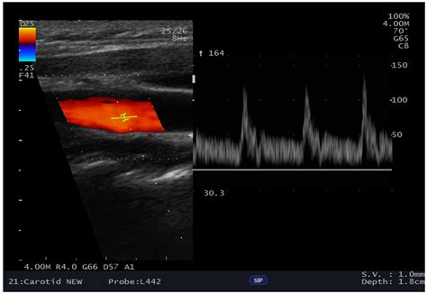 Spectral Doppler Wave Small Sample Volume Length Download Scientific
