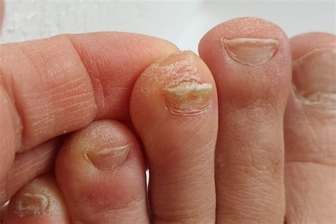 Nail Fungal Infection Treatment Nextmed Clinic