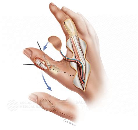 Reconstructive Surgery Of The Hand And Upper Extremity Ami 2019