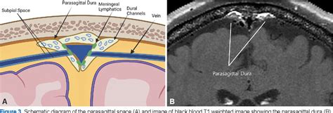 Figure 3 From Magnetic Resonance Imaging Of The Glymphatic System In The Human Brain Semantic