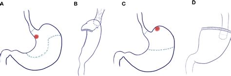 Scope Of Gastrectomy And Reconstruction Of Digestive Tract A Download Scientific Diagram