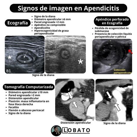 Signos Radiol Gicos De Apendicitis Lobato Md Udocz