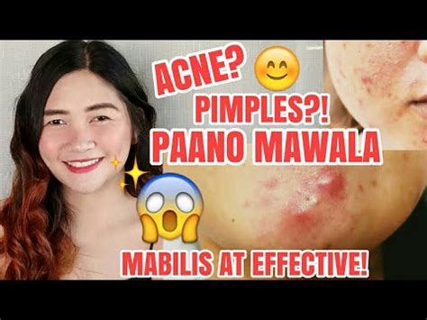 Mabisang Gamot Para Sa Pimple
