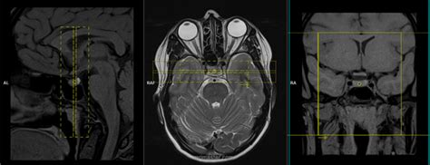 Pituitary Mri Protocols Planing And Indications Pituitary Dynamic
