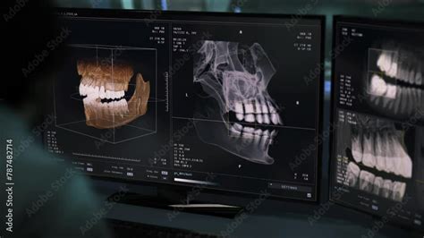 Hi Tech Tooth Health Analysis Process At The Dental Clinic Analysing The Tooth Health Using
