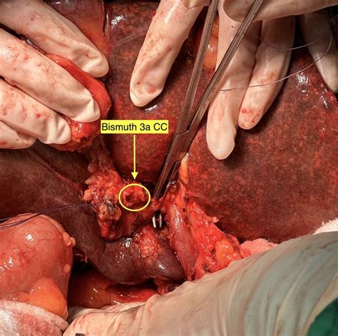 Adrian Bartos On Linkedin 67 Years Old Female Patient With Right Hepatectomy ‘en Bloc With