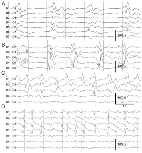 Electroencephalographic Periodic Discharges And Frequency Dependent Brain Tissue Hypoxia In