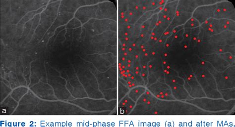 Figure 1 From Diabetic Microaneurysms Detected By Fluorescein