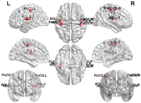 Connectome Analysis Of Brain Functional Network Alterations In