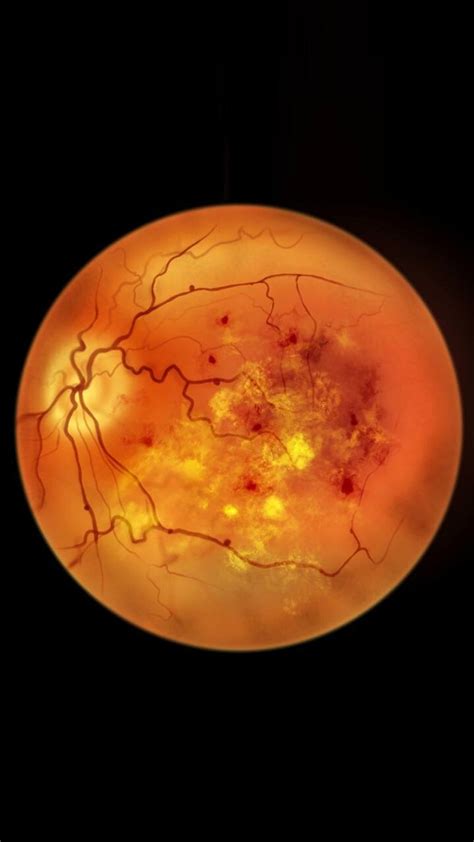 Diabetic Retinopathy Causes Symptoms And Treatments