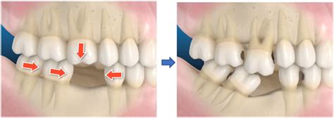Should You Replace Missing Teeth What Are The Consequences