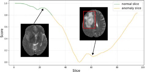 Normality Scores Of The Brain Mri Axial Slices Were Obtained By