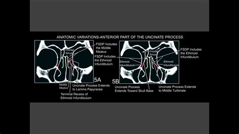 Uncinate Process Spine And Backbonescervical Vertebra Including Atlas