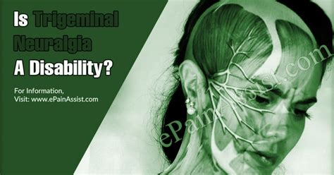 Icd 10 Code For Trigeminal Neuralgia Mytrigeminalneuralgia