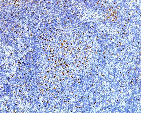 Pathology Outlines Reactive B Cell Rich Lymphoid Proliferations That Can Mimic Lymphoma