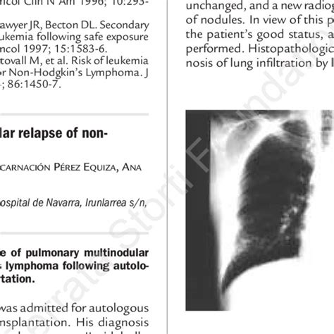 Chest Radiography Nodular Opacities Predominantly In Basal Zones