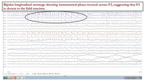 Principles Of Polarity In Eeg Principles Of Polarity In Eeg