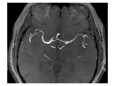 Anatomy Of The Anterior Cerebral Artery Aca Ppt