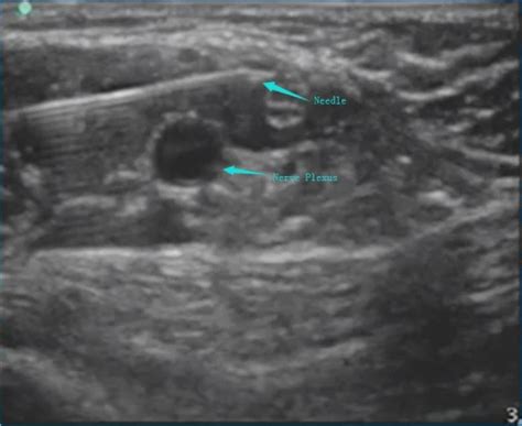 Echogenic Nerve Block Needle Echogenic Needle And Nerve