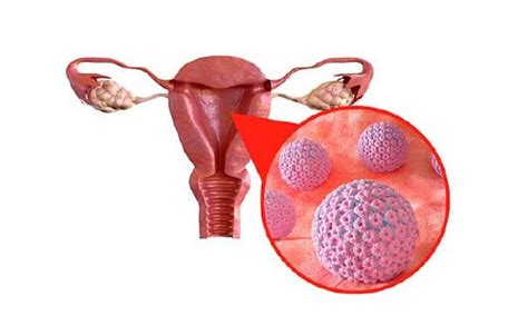 Anatomy Of A Wart The Golden Glue Gun Wart