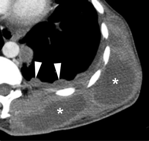 Contrast Enhanced Axial Computed Tomography Image On Soft Tissue Window Download Scientific