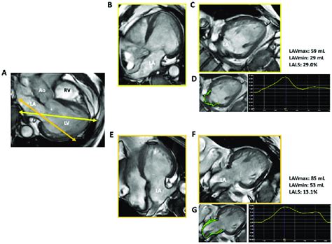 cmr feature tracking analysis of la a a cut plane optimized for the