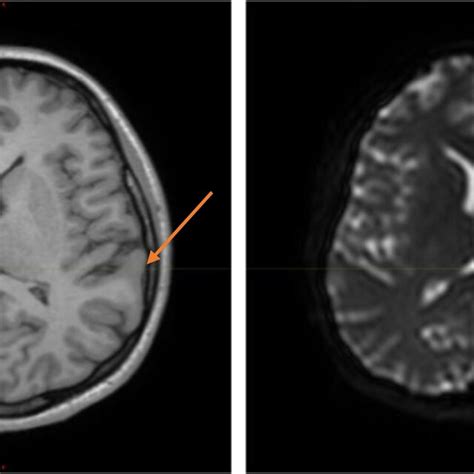Axial Mri At Level Of Wernickes Area T1 And T2 Weighted Download