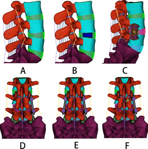 Fe Models Of The Lumbar Spine L3s1 A Intact Model B Stand Alone Download Scientific