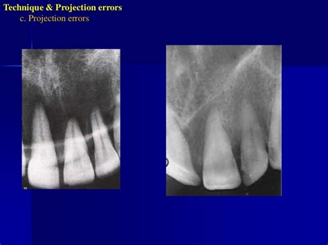 Radiographic Errors And Artifacts