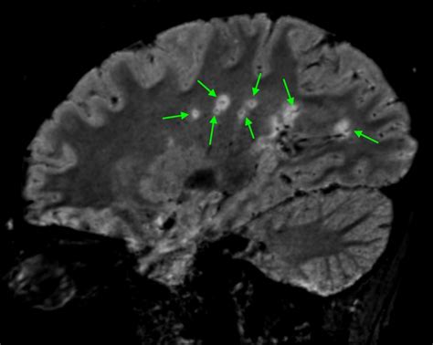 Diagnosing Multiple Sclerosis Ms Living Well