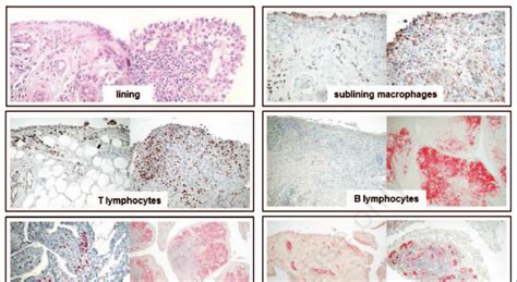 Synovial Tissue Heterogeneity Inter Individual Variations Of Synovial