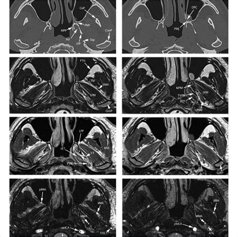 16 Infratemporal Fossa Approach Neupsy Key