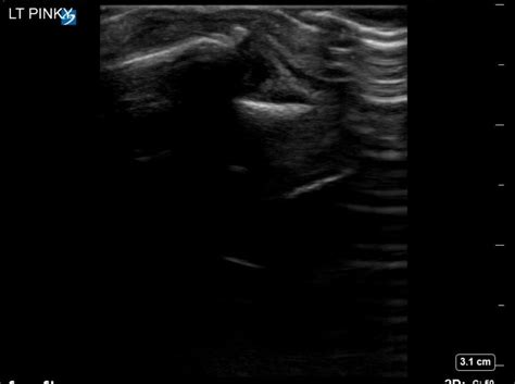 Finger Us Pinky Pipj Dislocation With Small Avulsion Fracture Wiki Sports Medicine R Finger Us Pinky Pipj Dislocation With Small Avulsion Fracture Wiki Sports Medicine R