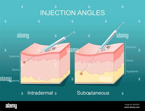 Injection Technique Needle Angle Cross Section Of Human Skin Layers With Syringe And Needle