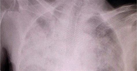 Phimaimedicine 3 026 Diffuse Alveolar Hemorrhage