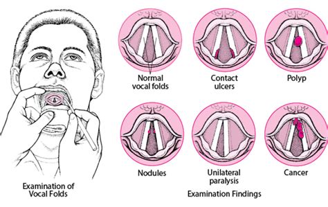 Vocal Fold Polyps Nodules And Granulomas Ear Nose And Throat Disorders Msd Manual