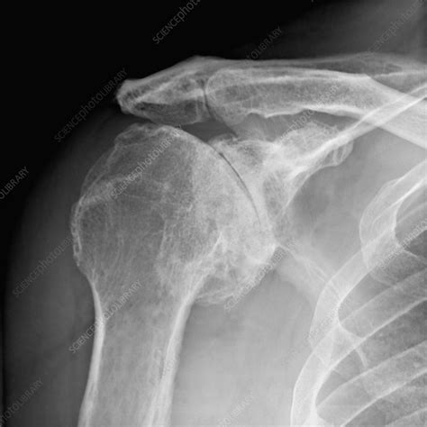 Osteoarthritis Of The Shoulder X Ray Stock Image C0372759
