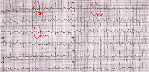 12 Lead Ecg Showing Mild Right Ventricular Delay And S1q3t3 Pattern