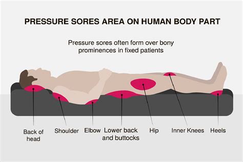 Wockhardt Education Initiative How Pressure Ulcers Bed Sore Kills Patients Wockhardt Hospitals