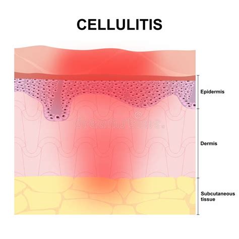 Cellulitis Skin Illustration Stock Image Illustration Of Highlights