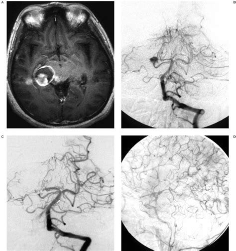 Endovascular Management For P2 Aneurysms Of The Posterior Cerebral
