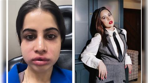 Urfi Javed ने 9 साल बाद हटवाए फिलर्स तो सूजे होंठ चेहरा हुआ लाल